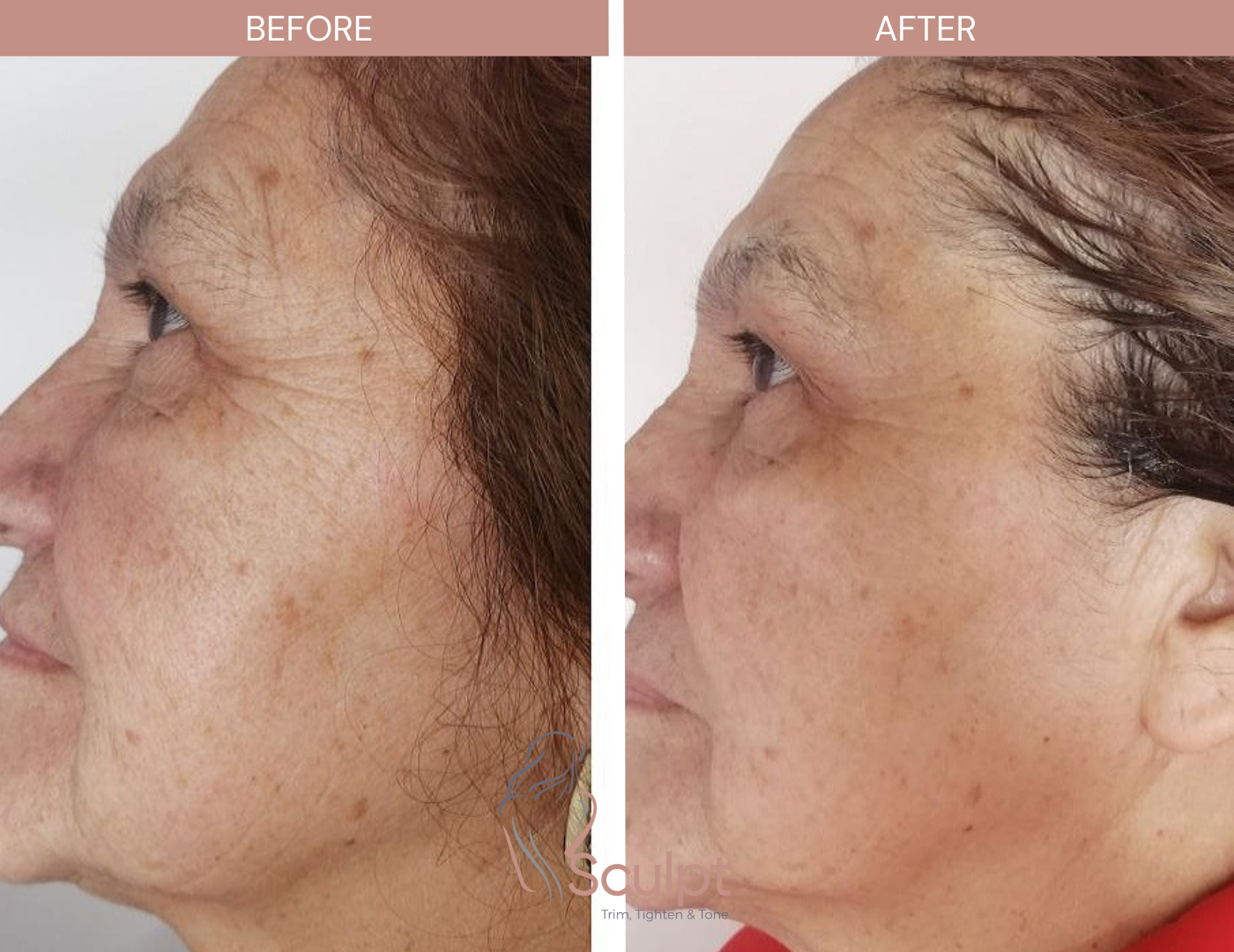 Skin Tightening - Sculpt Studio